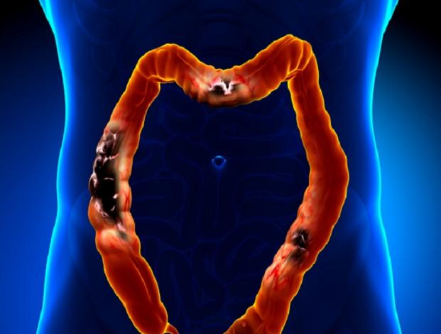Qué son y cómo se previenen los pólipos del colon Qué son y cómo se previenen los pólipos del colon